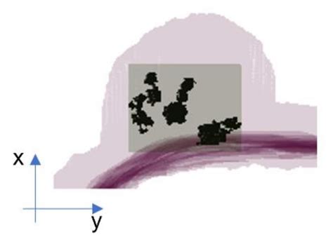 3t Mri Artificial Intelligence In Patients With Invasive Breast Cancer To Predict Distant