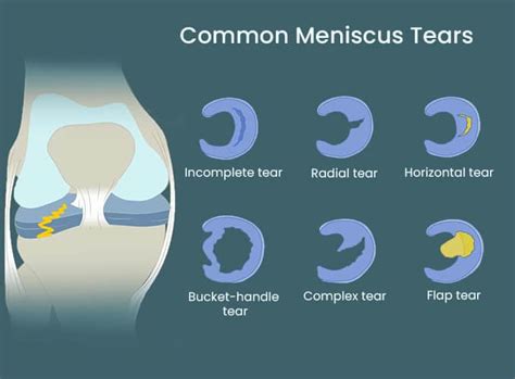 Lateral Meniscus Tear Posterior Horn 1640x924