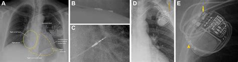 How I Do It Evaluating Cardiac Implantable Devices And Noncardiac