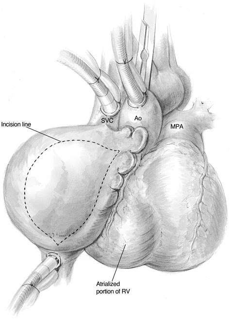 Fenestrated Right Ventricular Exclusion Starnes Procedure For Severe