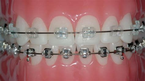 Braces With Ceramic Brackets At Margaret Steen Blog