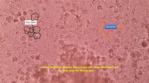 Bacteria In Urine Under Microscope