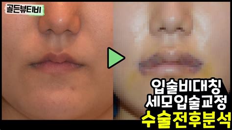 작은입술💋세모입술💋입술길어지는법💋입커지는방법 💋입술비대칭교정💋 입꼬리수술 전후 분석해보기💨 Youtube