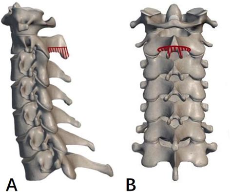 Schematic Diagram Of C2 Partial Laminectomy C2 Pl Ab The Red