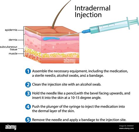 Intradermal Injection