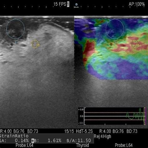 The Hypoechoic Lesion Is Showing Dark Blue Color On Elastography Score