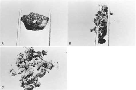 Recurrent Pyogenic Cholangitis Clinical Gate