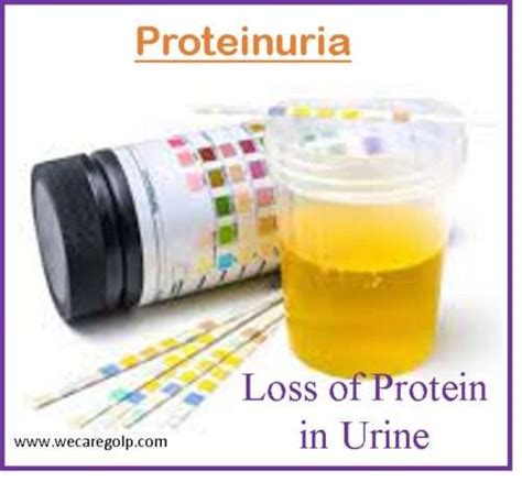 Protein Loss In Urine Proteinuria Symptoms Causes And 56 Off