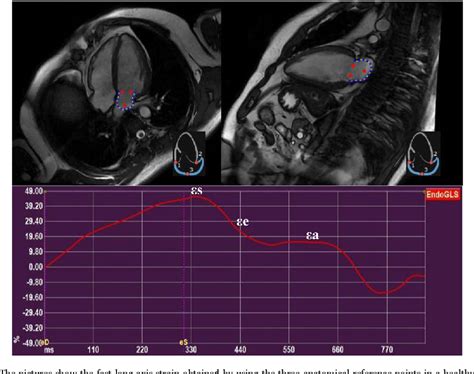Figure 1 From Application Of Left Atrial Strain Derived From Cardiac Magnetic Resonance Feature