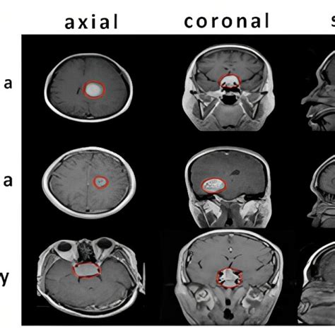 The Figure Shows That Brain Lesions Abnormalities Can Be Classified Download Scientific Diagram
