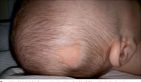 Figure 1 From Nevus Sebaceous On The Scalp Answer Semantic Scholar