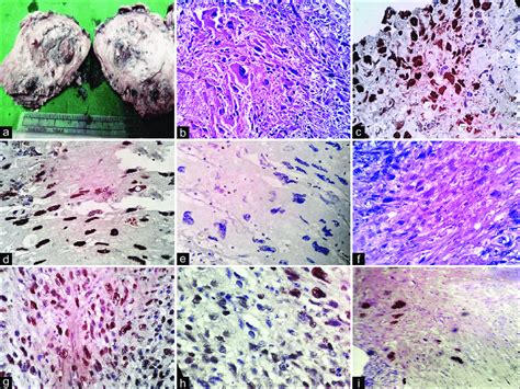 Choriocarcinoma Gross Image
