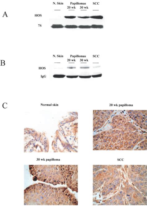 Expression Of MHOS In Mouse Skin Tumors A Northern Blot Analysis Of