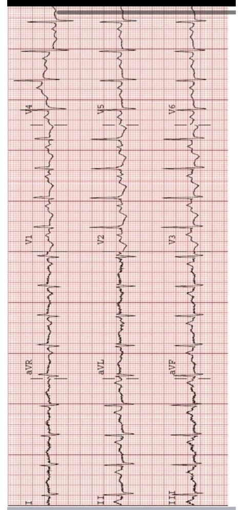 Ecg Interpretation R Ecg