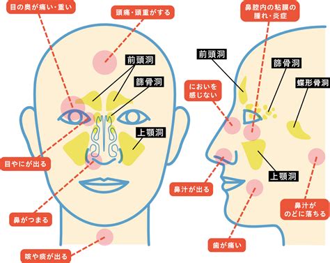 早めの受診で改善！ 副鼻腔炎 広報誌「高松日赤だより なんがでっきょんな」 高松赤十字病院 日本赤十字社 [香川県]