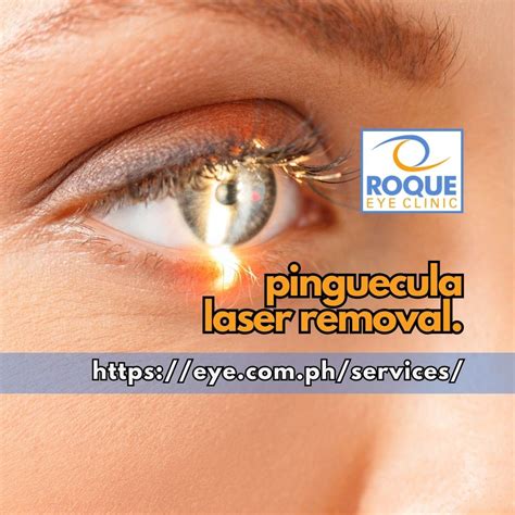 Pinguecula Laser Removal One Eye Pf Only Roque Eye Clinic Eye