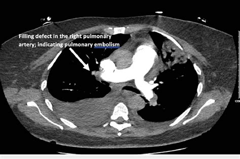 Ct Pulmonary Angiography Showing Multifocal Pulmonary Emboli Involving