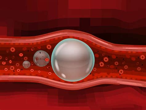 What Is Decompression Sickness And How Does It Occur