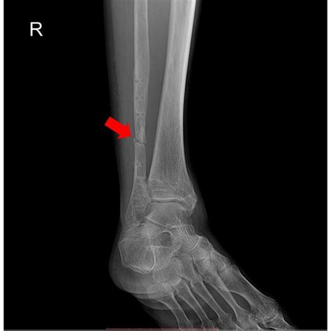발목 비골골절 치료와 재활 시 더 빠르게 회복하는 방법은 네이버 블로그