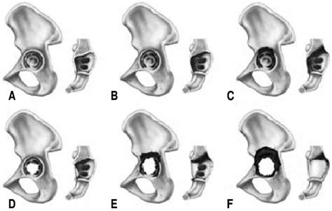 Clasificación Osteólisis Acetabular De Paprosky A Tipo I B Tipo Download Scientific