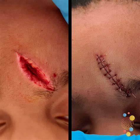 Lacerations Skin Deep