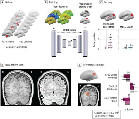 Detection Of Epileptogenic Focal Cortical Dysplasia Using Graph Neural Gavin Winston