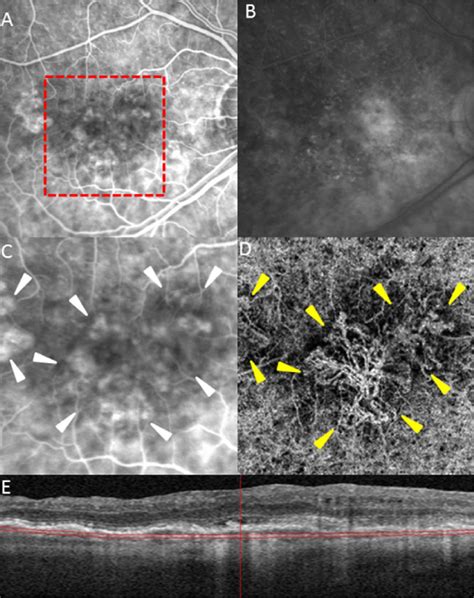 Tangled Morphology Of Type 1 Neovascularization As Imaged With Fa And Download Scientific