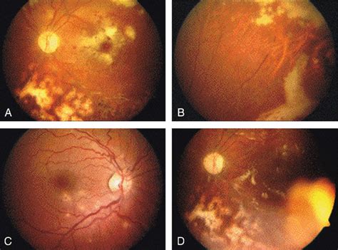 A B Left Eye Showing Retinal Necrosis Occlusive Vasculitis And Disk Download Scientific