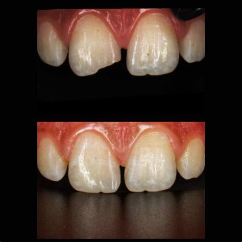 Esthetic Class Iv Composite Restoration Myzerodonto