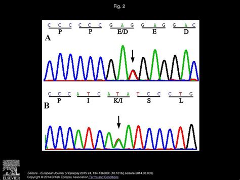 Normokalemic Periodic Paralysis With Involuntary Movements And Generalized Epilepsy Associated
