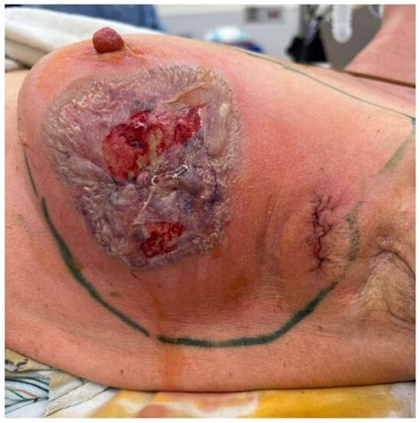 Resolution Of Pyoderma Gangrenosum During Adjuvant Breast Cancer Therapy