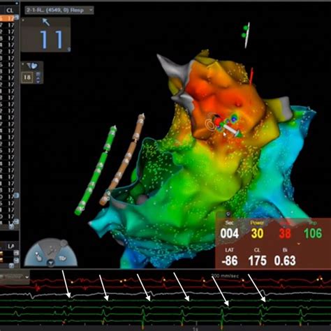 Atrial Flutter Is Seen With A Tachycardia Cycle Length Of 175 Ms Download Scientific Diagram