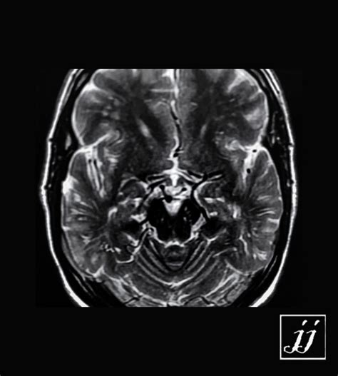 Subdural Hematoma Radiopaedia