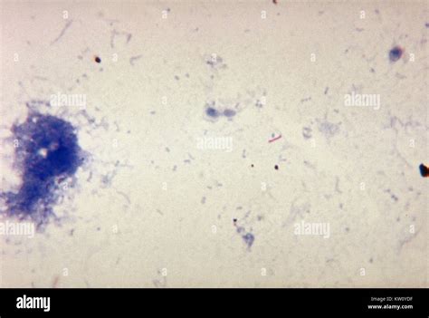 Mycobacterium Tuberculosis Acid Fast Stain