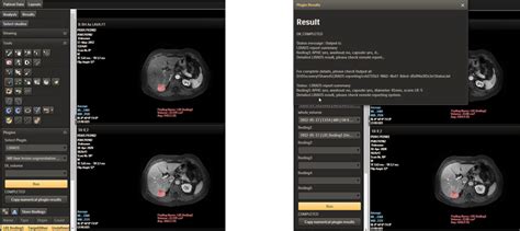 Li Rads Plugin In Isd Li Rads Liver Imaging Reporting And Data