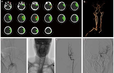The CTP A CTA B And DSA C F Images A The CTP Images Showed A Download Scientific