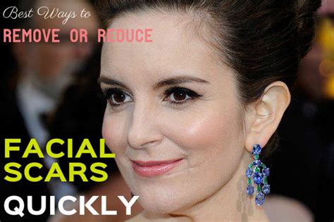 Best Ways To Remove Or Reduce Facial Scars Quickly Stylish Walks