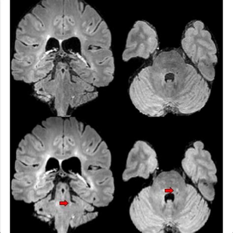 An Example Of Lesion Detected By Expert 1 In The First Phase Of The