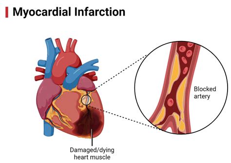 Myocardium Endocardium And Pericardium