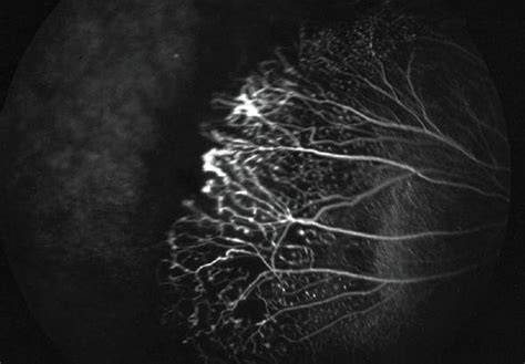 Update In Understanding And Managing Fevr Retina Today