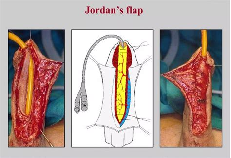 One Stage Urethroplasty Of Penile Urethra Using Penile Skin Flap Pdf