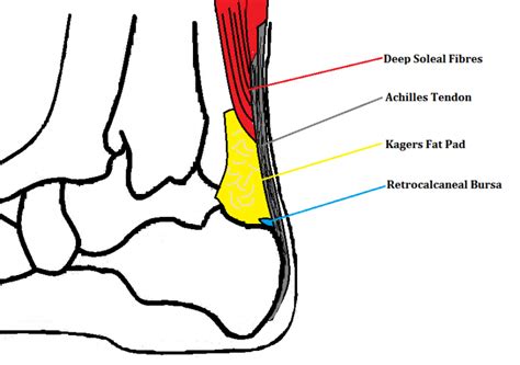 Kagers Fat Pad Irritation Ankle Foot And Orthotic Centre