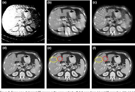 Figure 4 From Ai Enabled Ultra Low Dose Ct Reconstruction Semantic Scholar