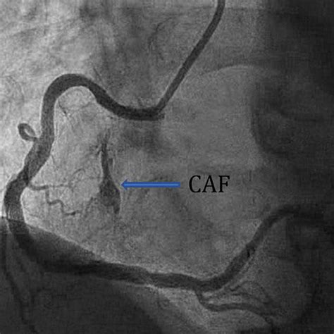 Coronary Angiogram Of Patient In Case 1 Ccf Of Lcx Emptying Into Lv