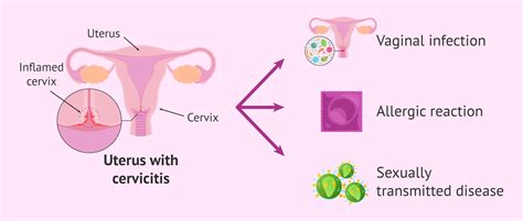 Possible Causes Of Cervicitis