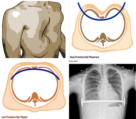 Chest Wall Deformities Dr Rami Hamed Center