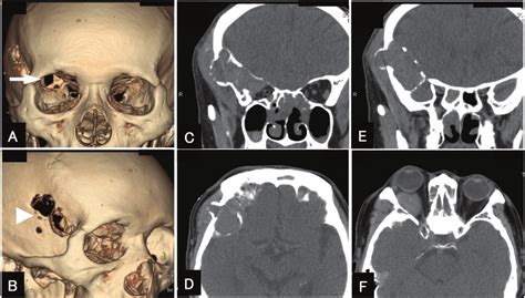 Preoperative CT Images Constructed By Surface Rendering A And B Download Scientific Diagram