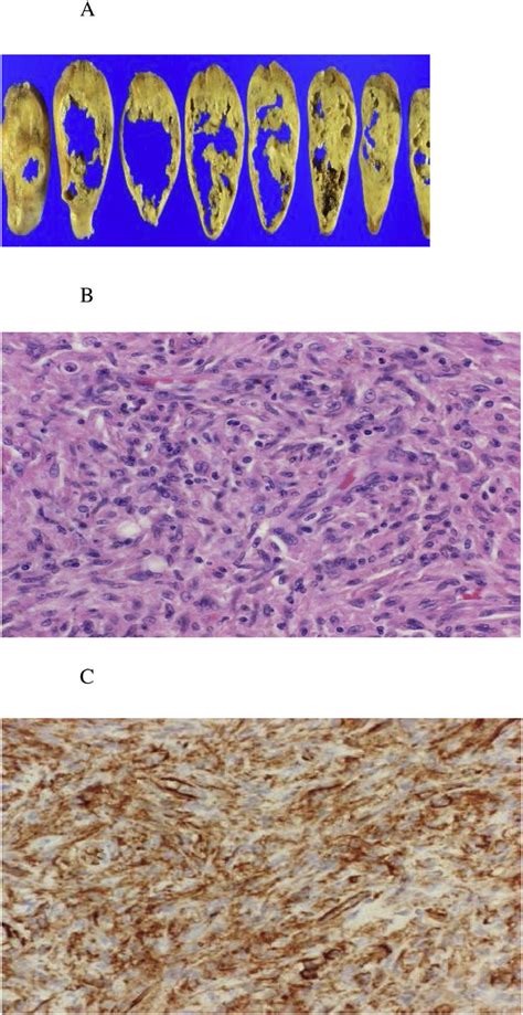Aleft Lower Lobe Of The Lung Segmental Resection Specimen S9 4 Cm Â