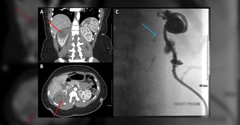 An Obstructed Upper Pole Moiety Of A Duplicated Renal Collecting System Versus An Infected Renal