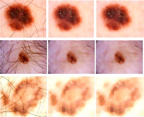 Figure 2 From An Iomt Based Melanoma Lesion Segmentation Using